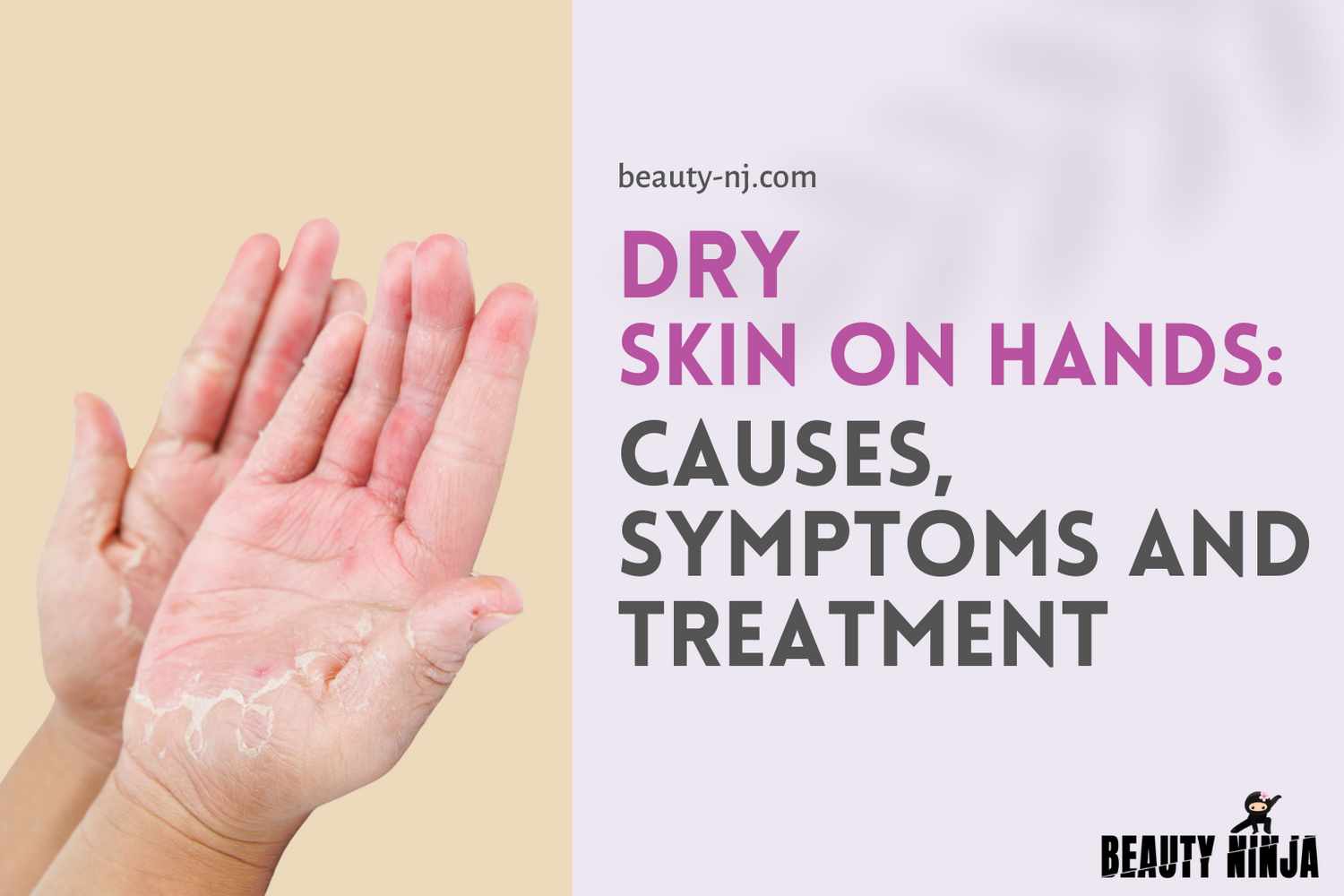 Dry Skin on Hands: Causes, Symptoms and Treatment - Beauty Ninja ...