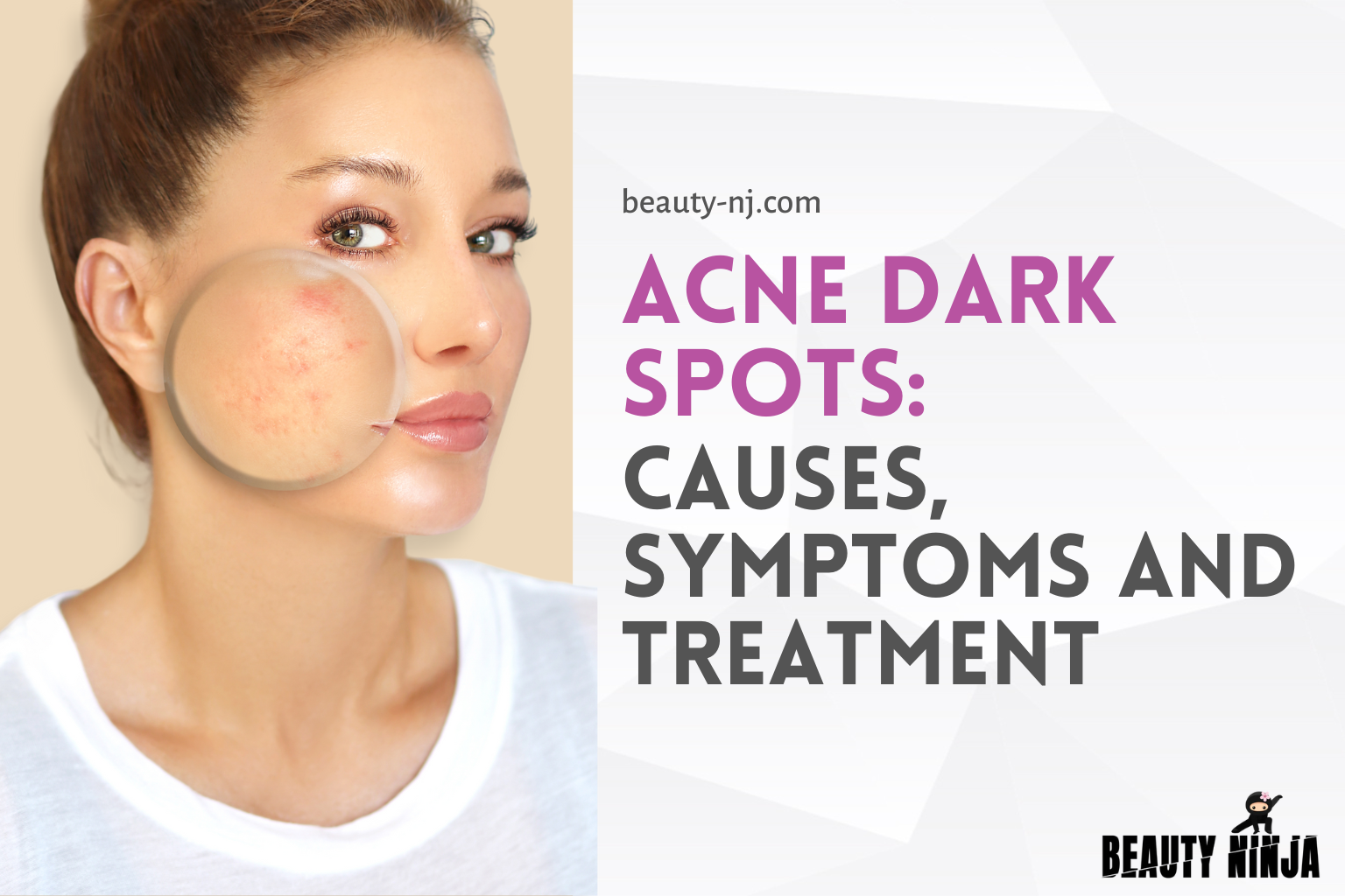 Acne Dark Spots: Causes, Symptoms, and Treatment - Beauty Ninja
